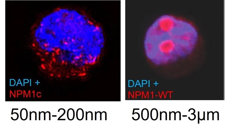 突变NPM1蛋白在急性髓系白血病发生中的分子机制_人民号